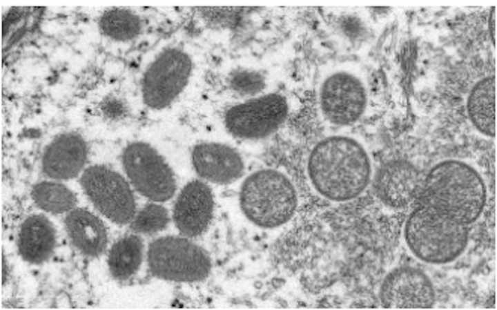 Number Of States With Confirmed Or Suspected Monkeypox Cases Climbs To ... Number Of States With Confirmed Or Suspected Monkeypox Cases Climbs To ...