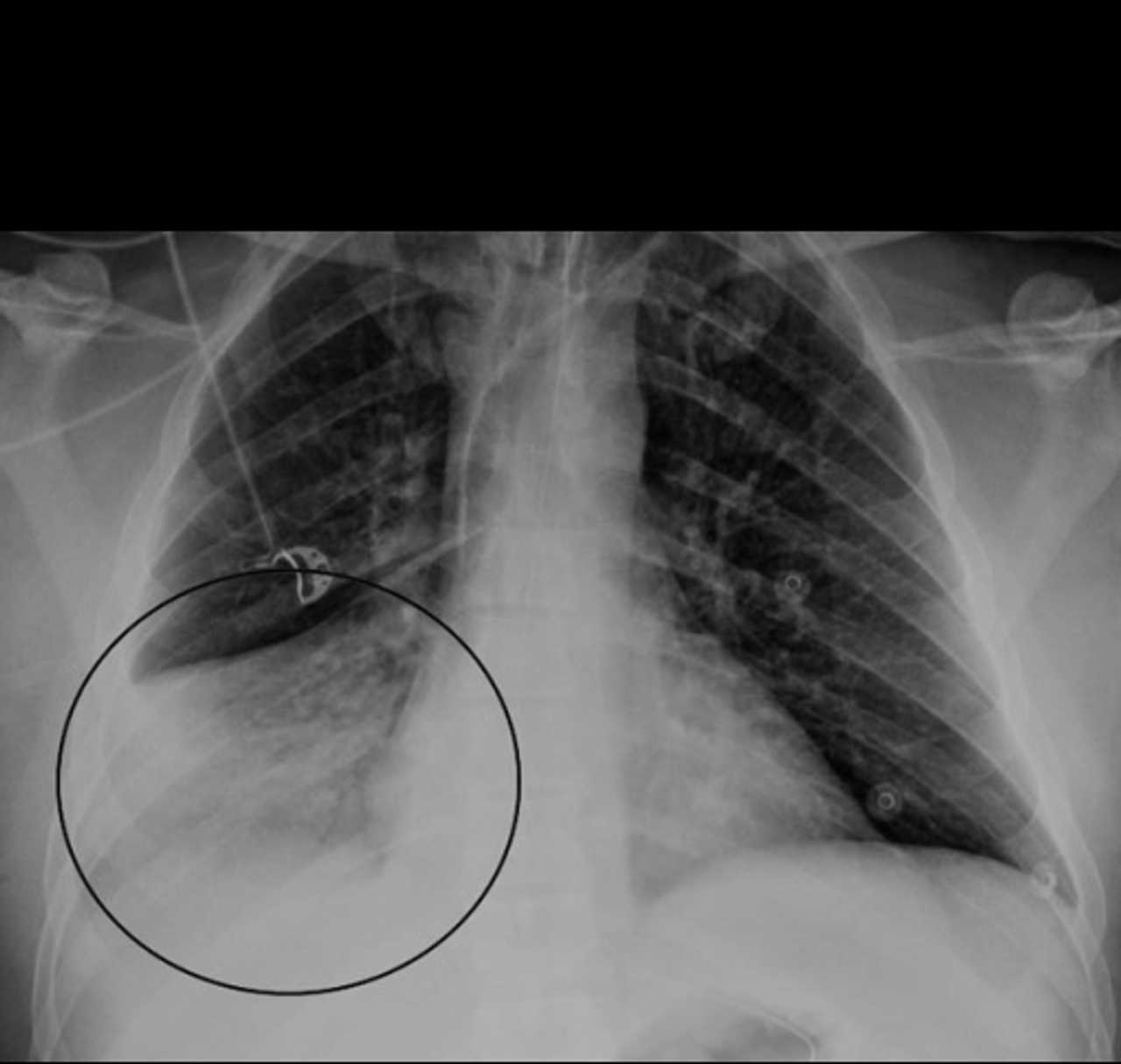 HMPV Outbreak in China: Symptoms, Risks, and Prevention Tips – Archyde HMPV Outbreak in China: Symptoms, Risks, and Prevention Tips – Archyde
