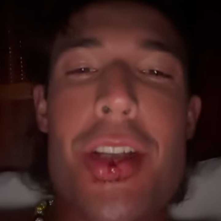 Watch: Savannah Bananas Star Face-Plant Mid-Flip On Live TV | Newark ...